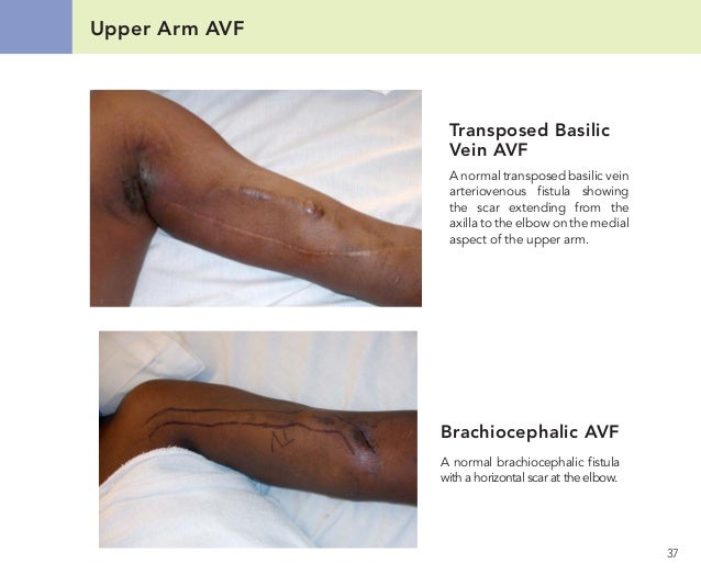 Atlas of dialysis vascular access