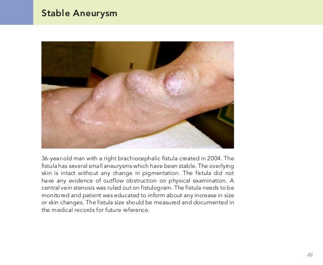 Atlas of dialysis vascular access