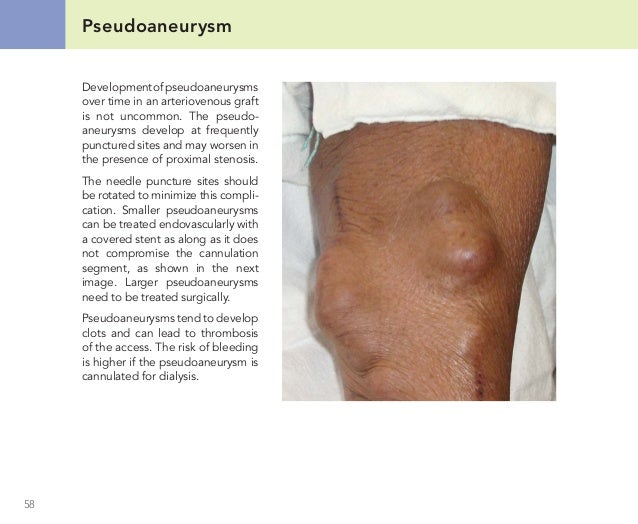 Atlas of dialysis vascular access