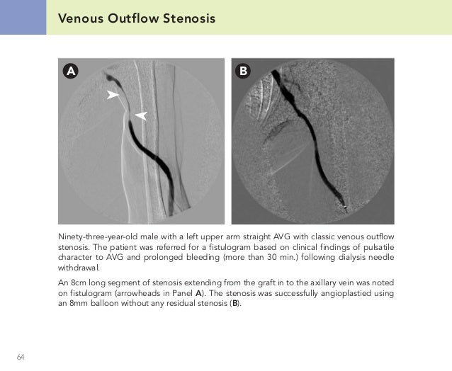 Atlas of dialysis vascular access