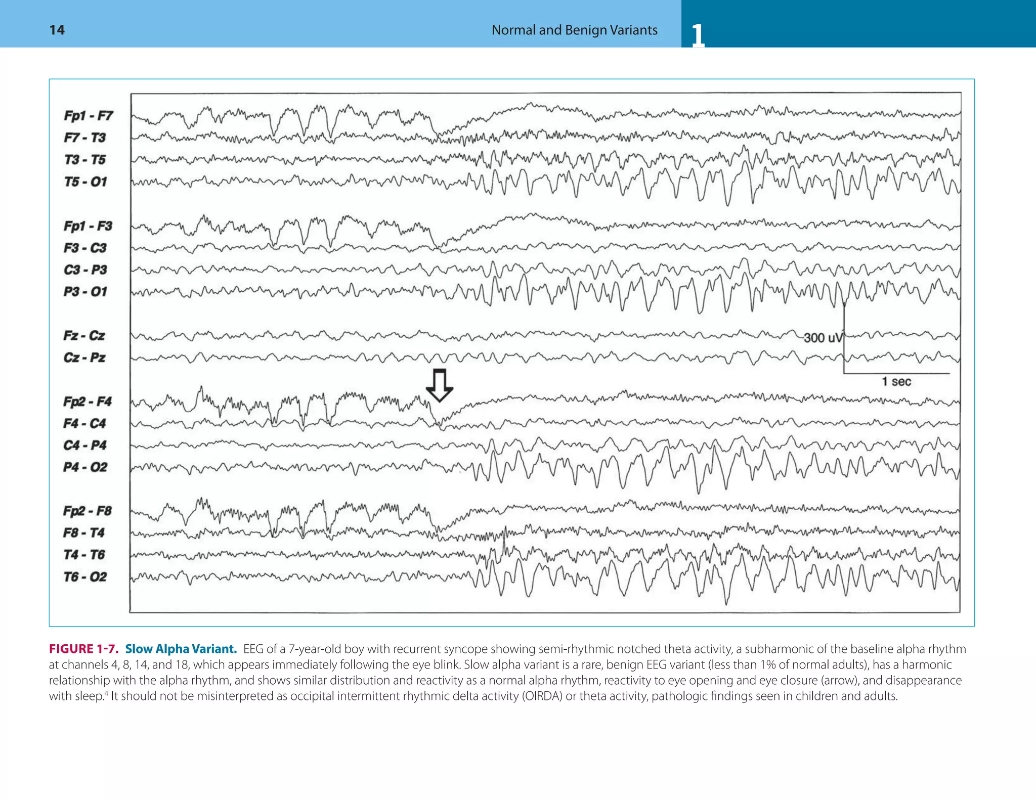 ATLAS OF EEG.pdf