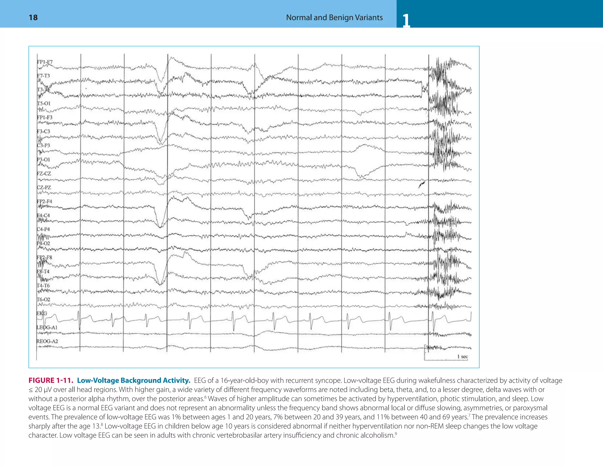 ATLAS OF EEG.pdf