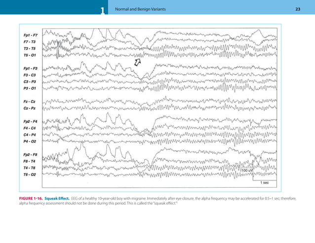 ATLAS OF EEG.pdf