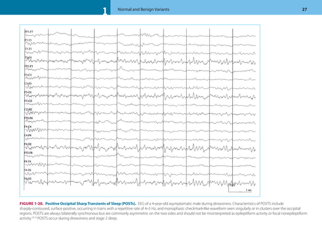 ATLAS OF EEG.pdf