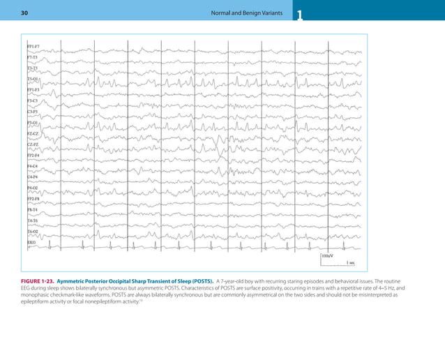 ATLAS OF EEG.pdf