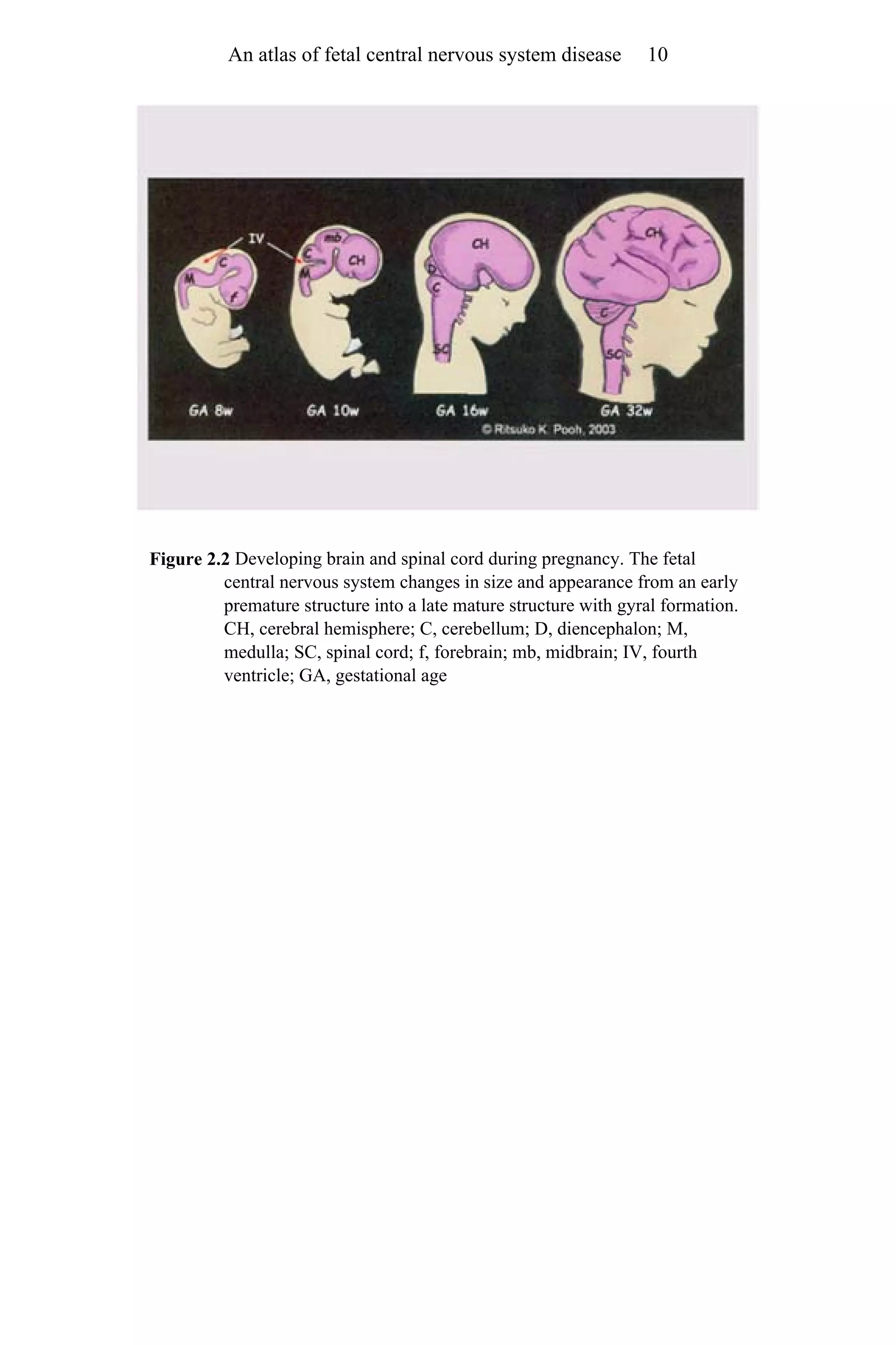 ATLAS OF FETAL CENTRAL NERVOUS SYSTEM DISEASE.pdf
