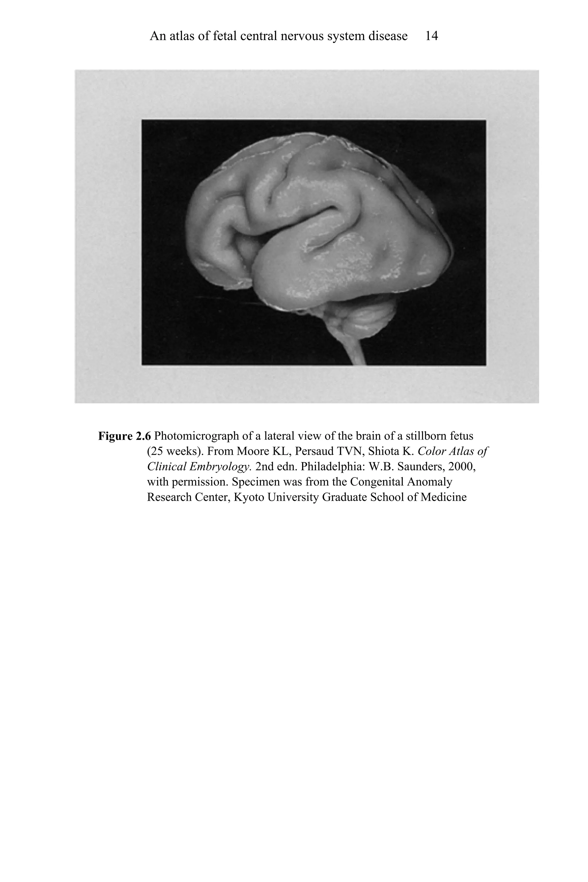 ATLAS OF FETAL CENTRAL NERVOUS SYSTEM DISEASE.pdf