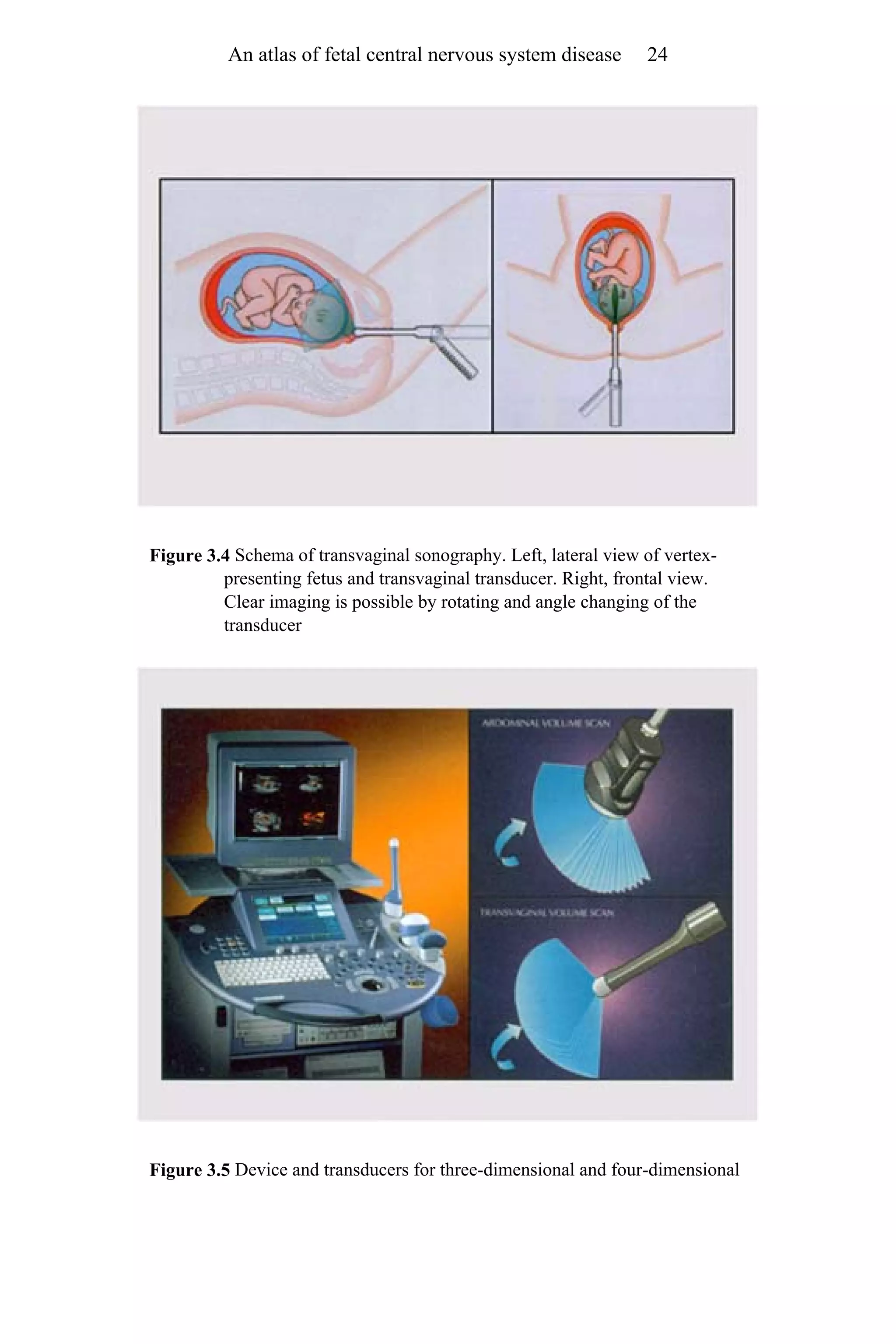 ATLAS OF FETAL CENTRAL NERVOUS SYSTEM DISEASE.pdf