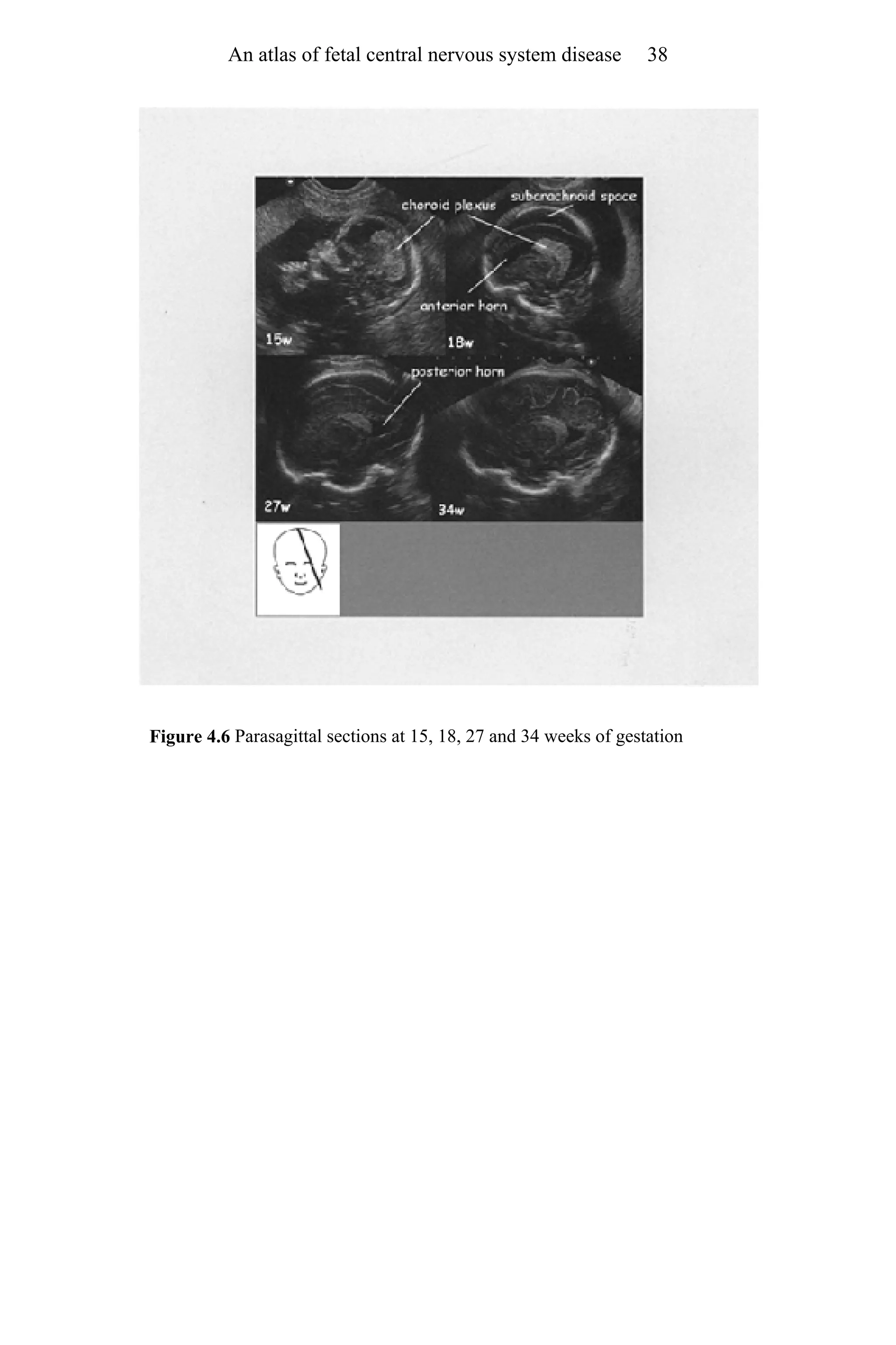 ATLAS OF FETAL CENTRAL NERVOUS SYSTEM DISEASE.pdf