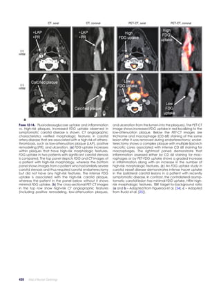 Atlas of nuclear cardiology | PDF