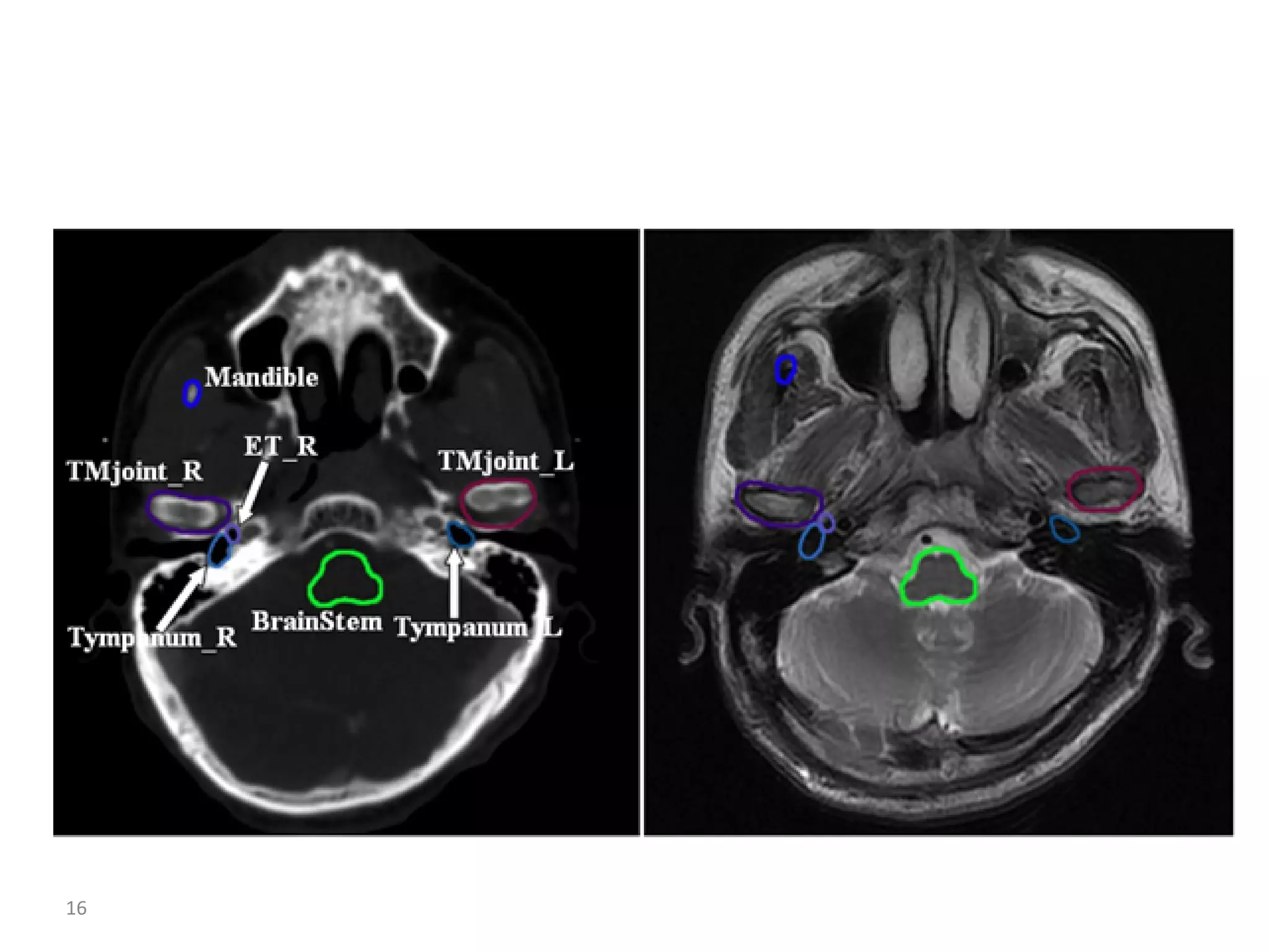 Atlas of organs at risk delineation head and neck region | PDF