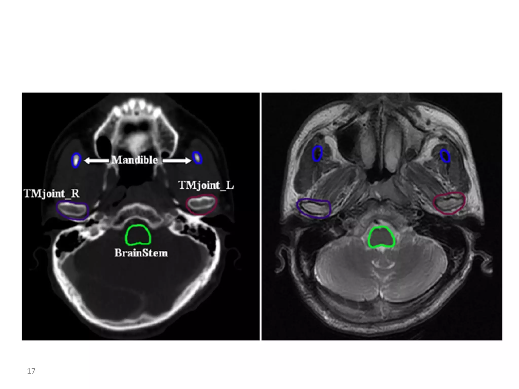 Atlas of organs at risk delineation head and neck region | PDF