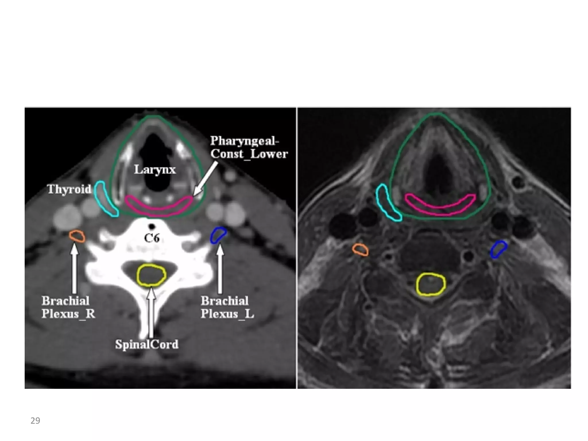 Atlas of organs at risk delineation head and neck region | PDF