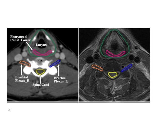 Atlas of organs at risk delineation head and neck region | PDF