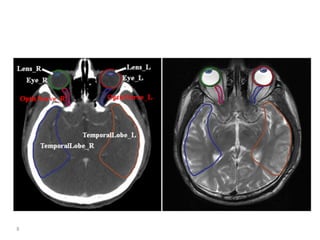 Atlas of organs at risk delineation head and neck region | PDF