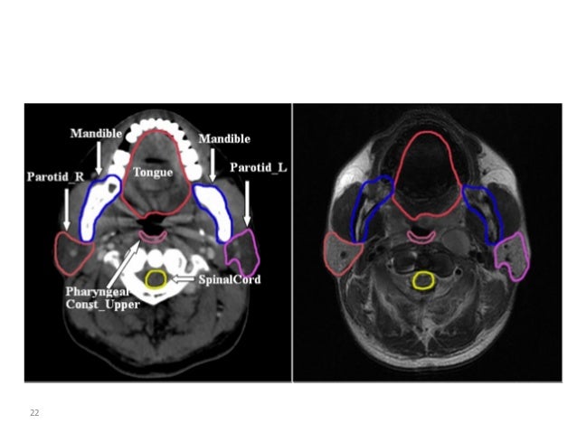 Atlas of organs at risk delineation head and neck region