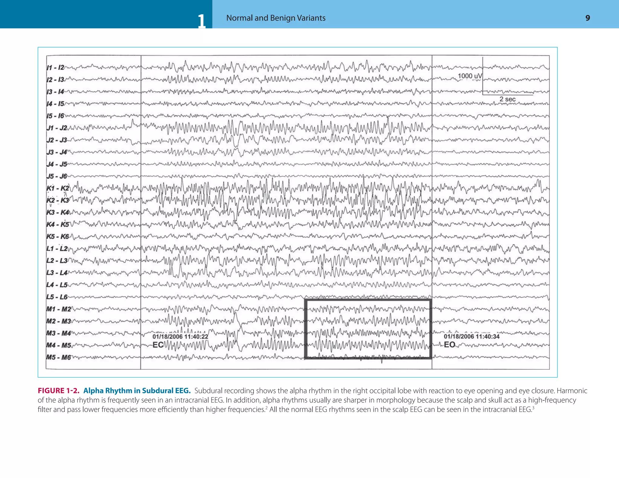 Atlas of Pediatric EEG.pdf