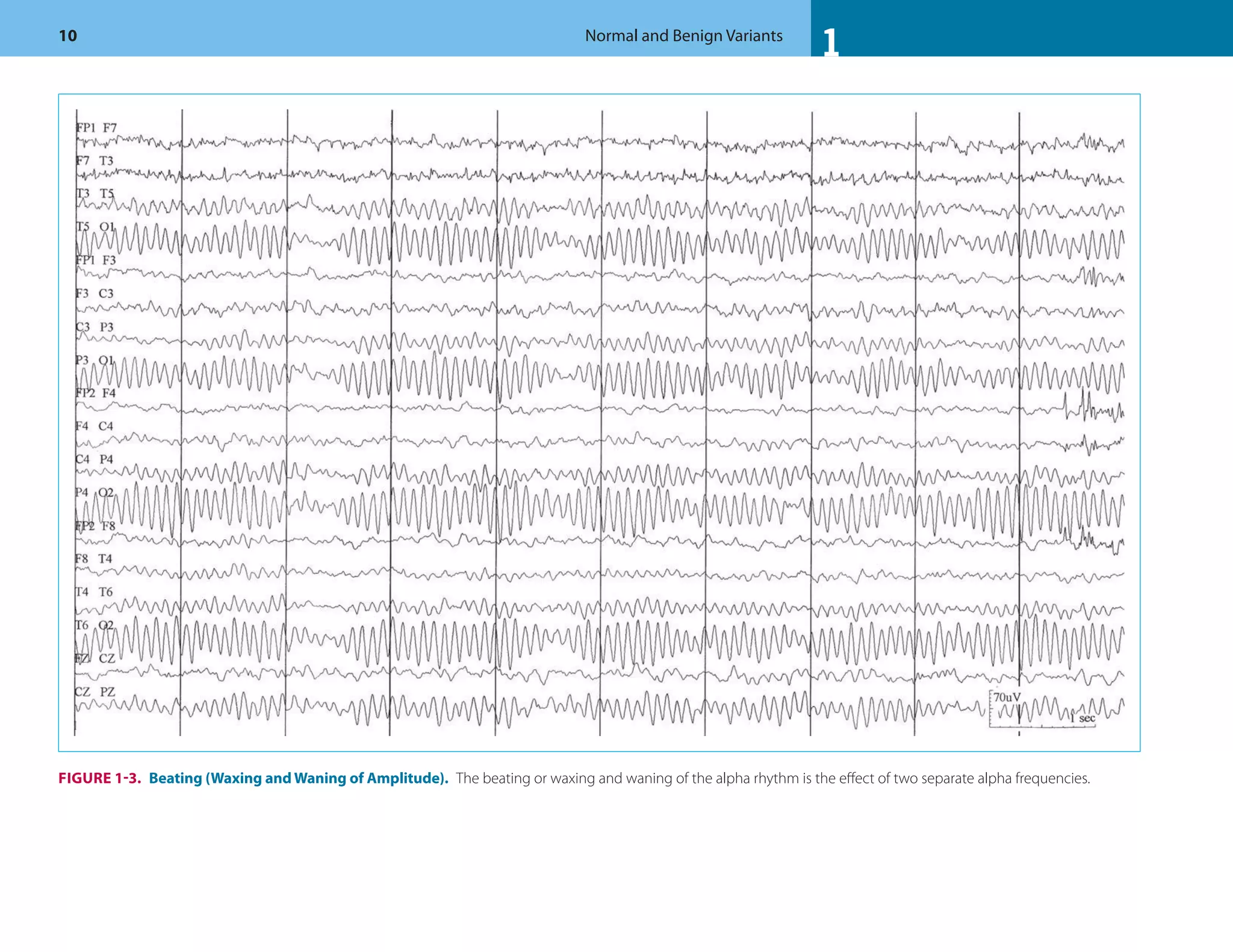 Atlas of Pediatric EEG.pdf