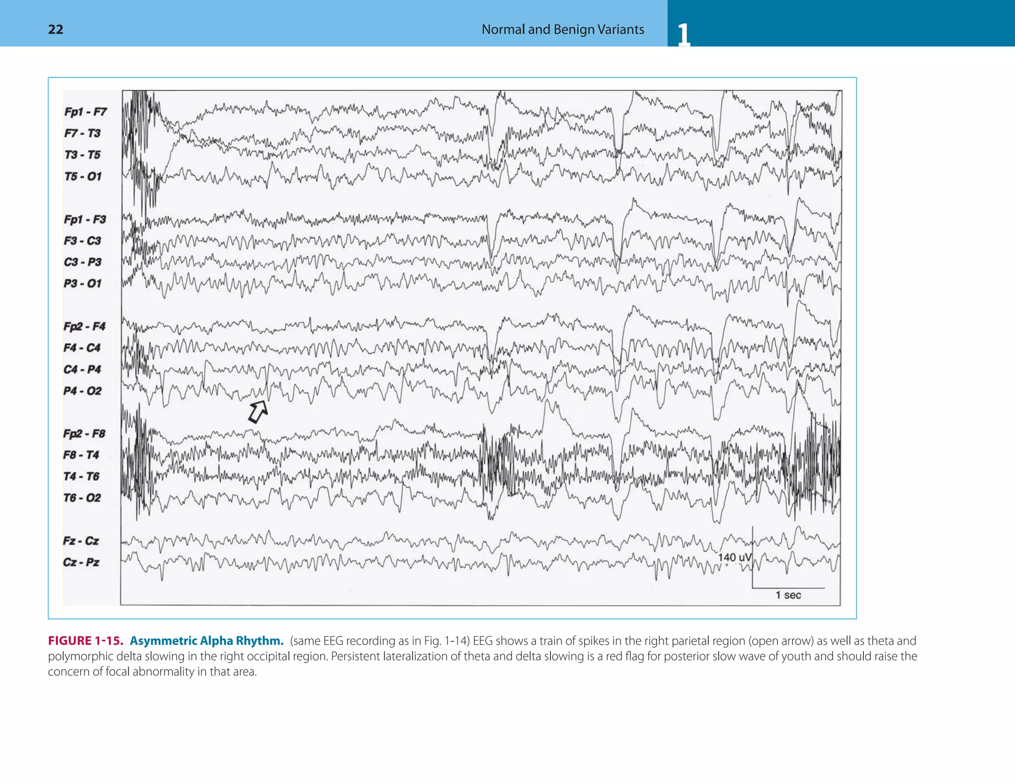 Atlas of Pediatric EEG.pdf