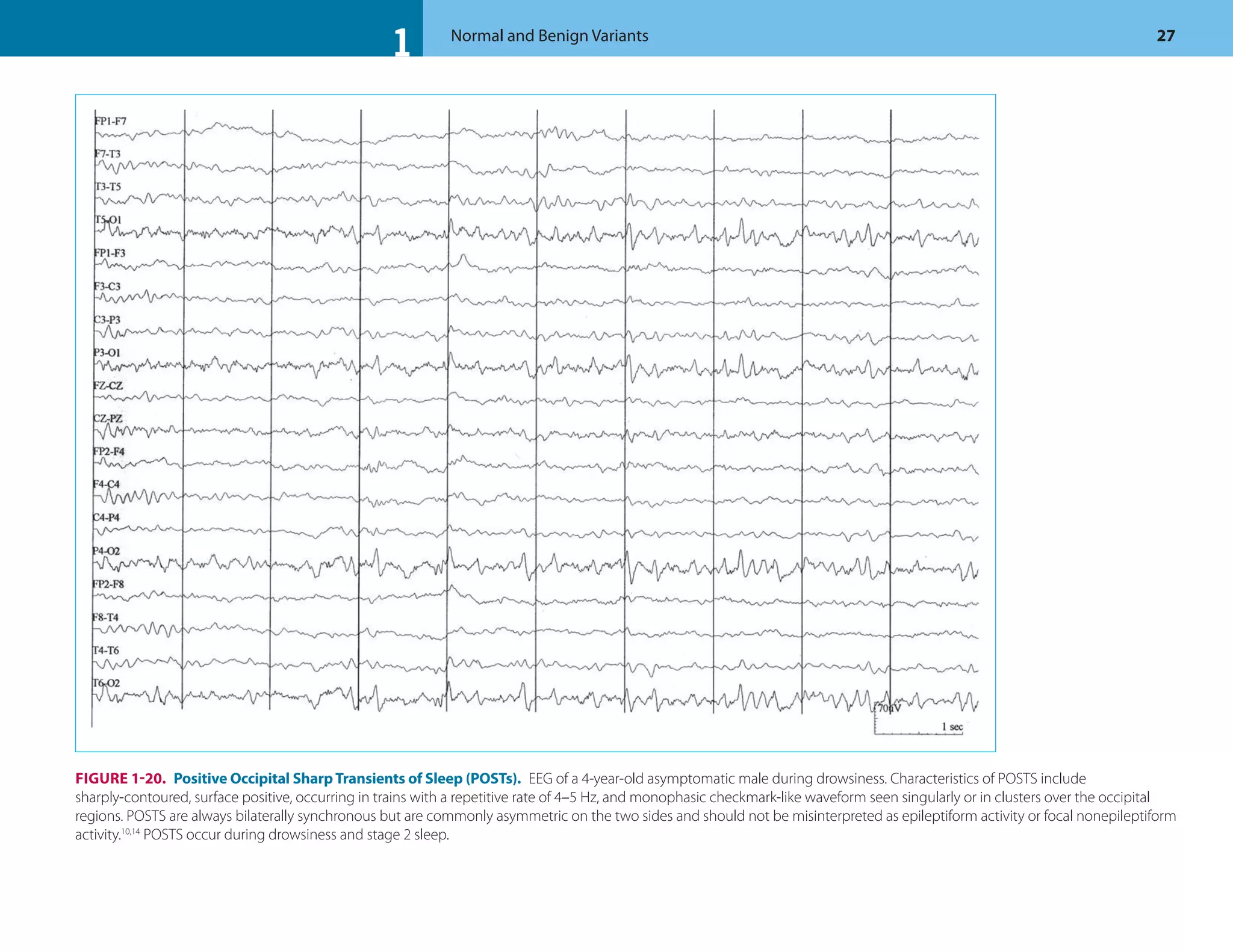 Atlas of Pediatric EEG.pdf
