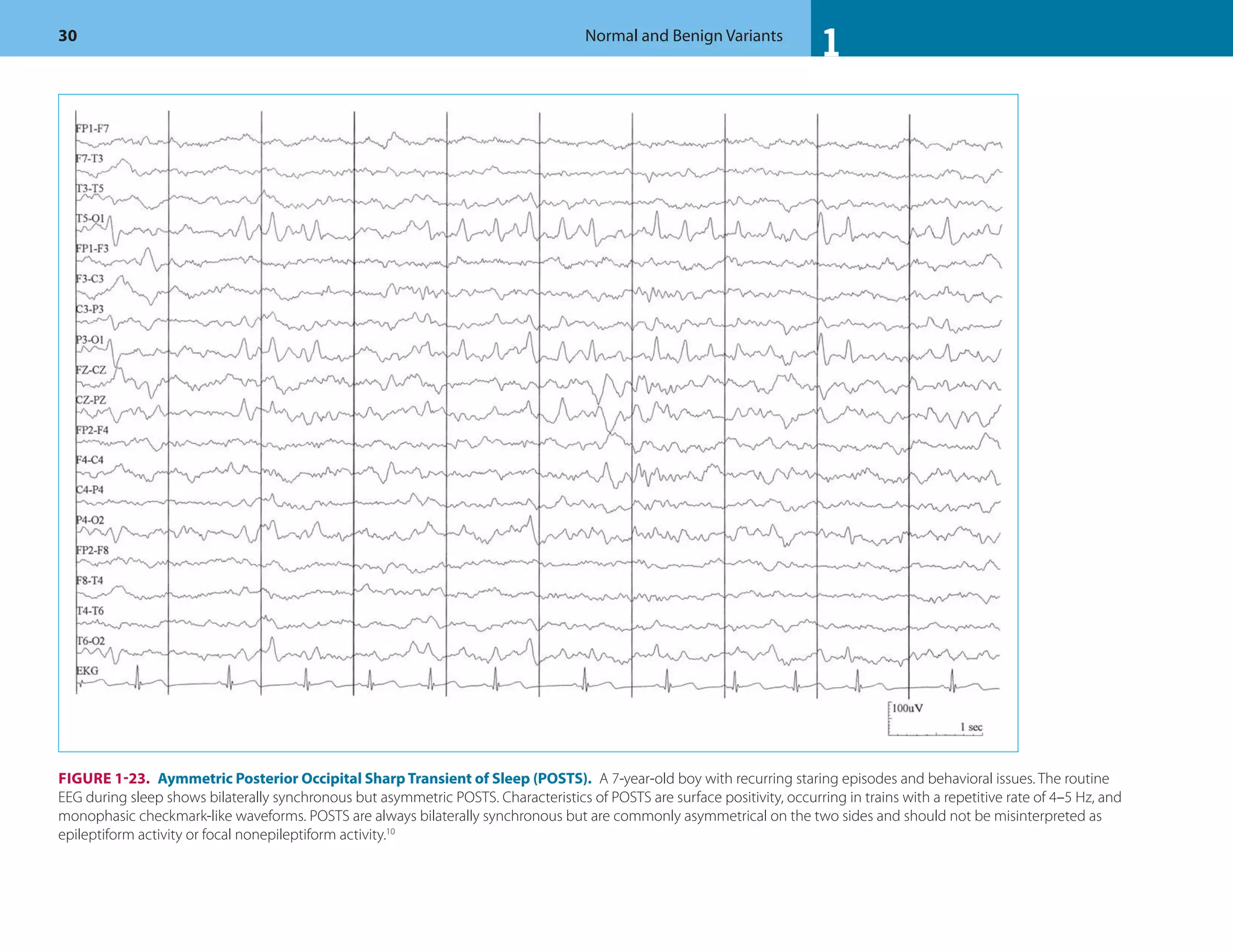 Atlas of Pediatric EEG.pdf