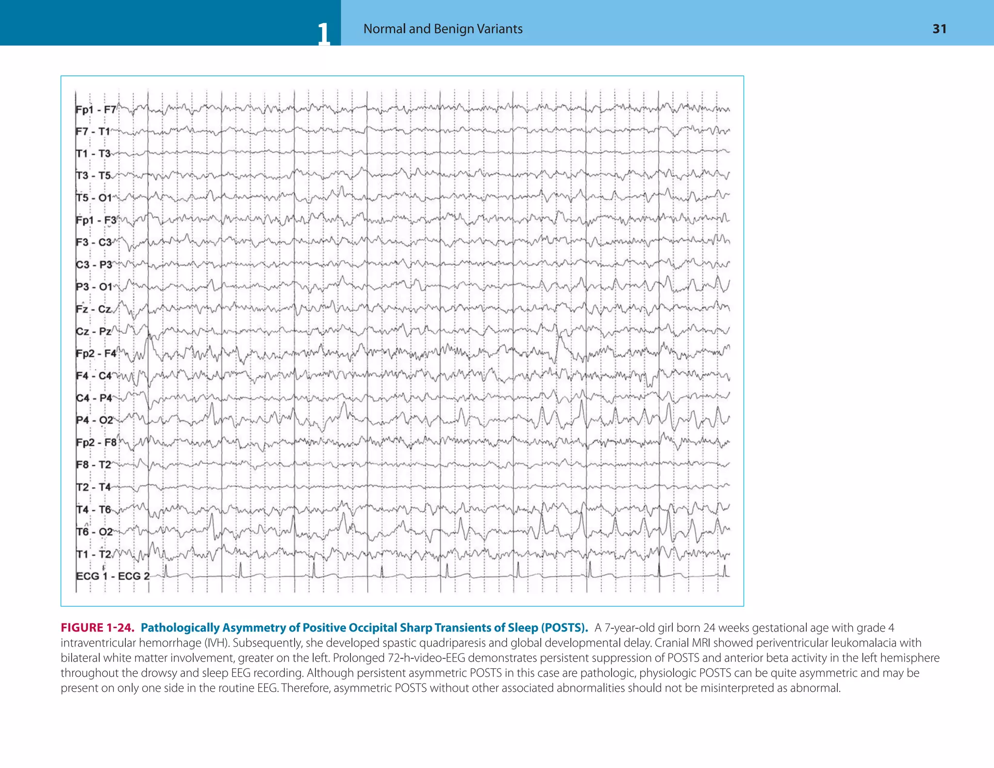 Atlas of Pediatric EEG.pdf