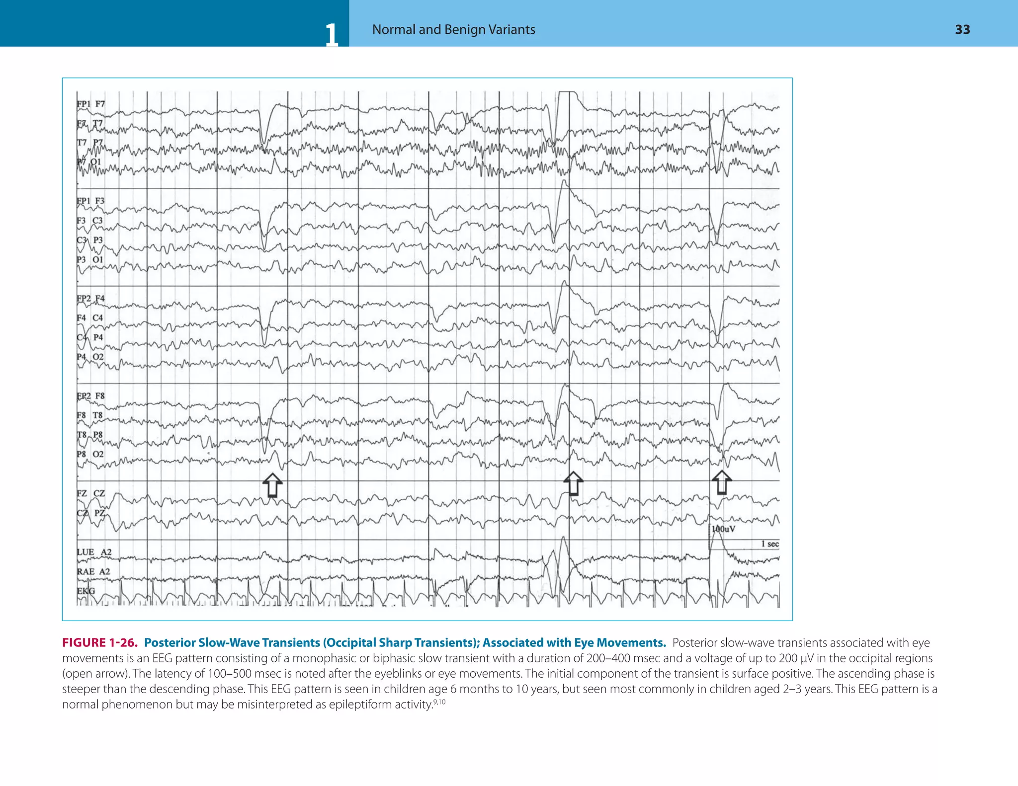 Atlas of Pediatric EEG.pdf