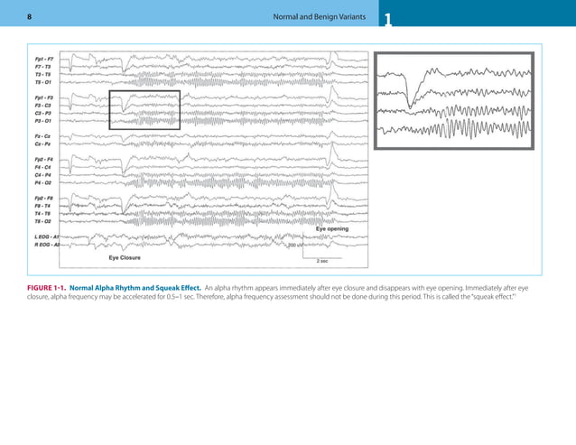 Atlas of Pediatric EEG.pdf