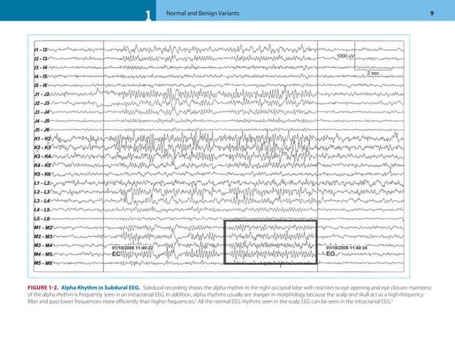 Atlas of Pediatric EEG.pdf