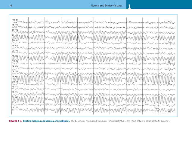 Atlas of Pediatric EEG.pdf