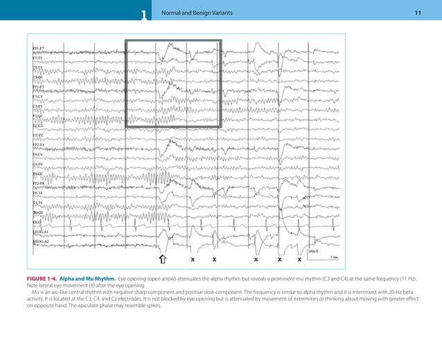 Atlas of Pediatric EEG.pdf