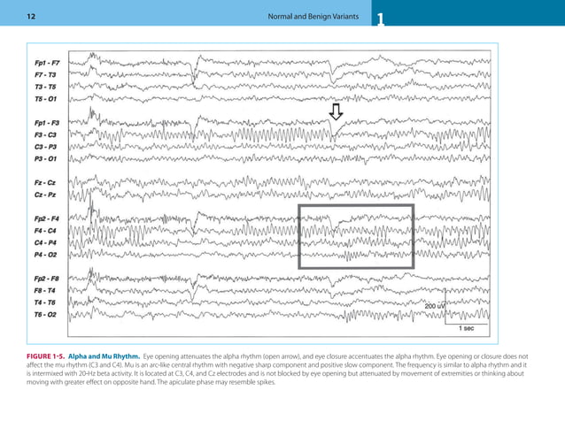 Atlas of Pediatric EEG.pdf
