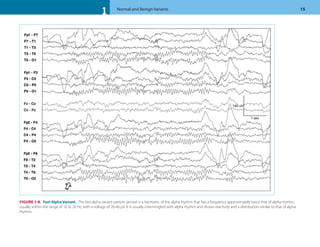 Atlas of Pediatric EEG.pdf