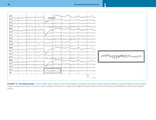 Atlas of Pediatric EEG.pdf