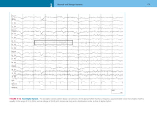 Atlas of Pediatric EEG.pdf