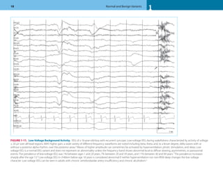 Atlas of Pediatric EEG.pdf