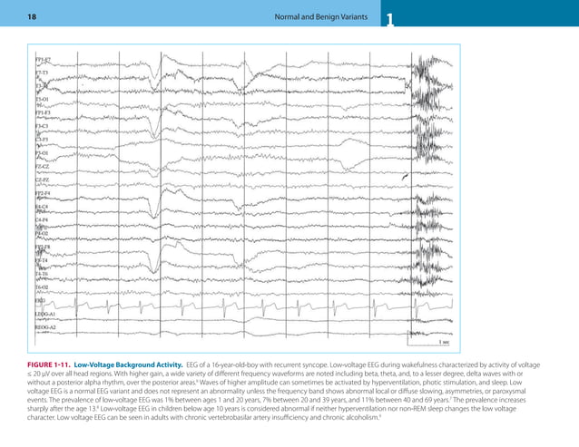 Atlas of Pediatric EEG.pdf