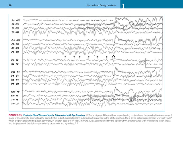 Atlas of Pediatric EEG.pdf