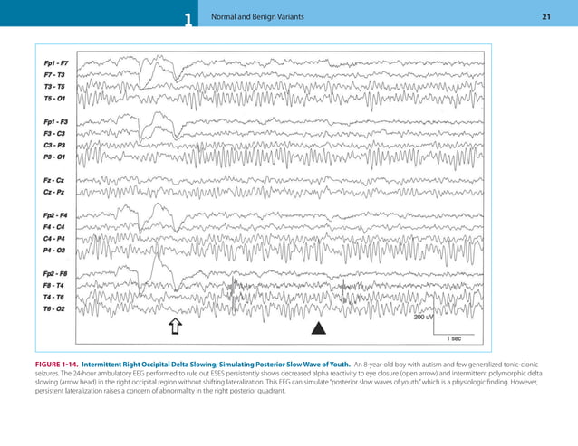 Atlas of Pediatric EEG.pdf