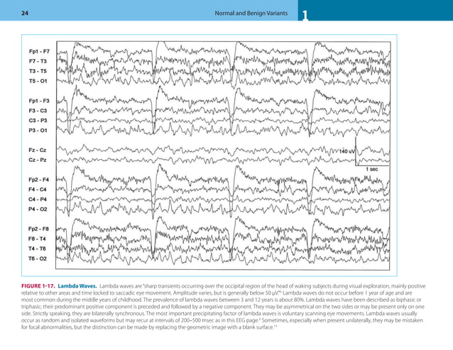 Atlas of Pediatric EEG.pdf