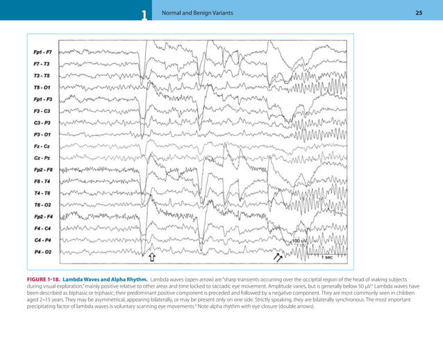 Atlas of Pediatric EEG.pdf