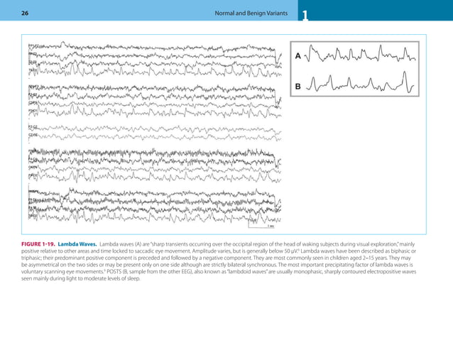 Atlas of Pediatric EEG.pdf