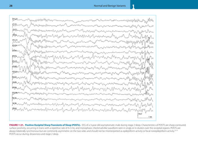 Atlas of Pediatric EEG.pdf