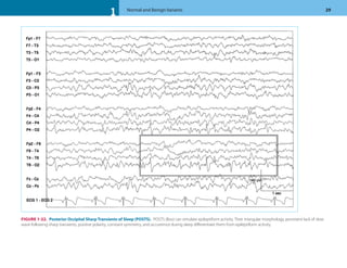 Atlas of Pediatric EEG.pdf