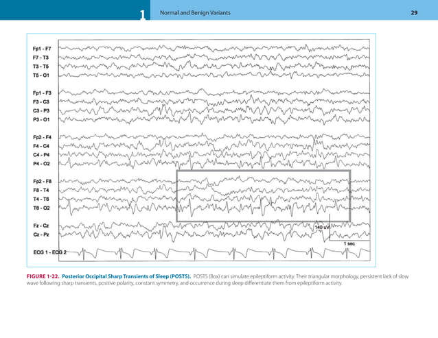 Atlas of Pediatric EEG.pdf