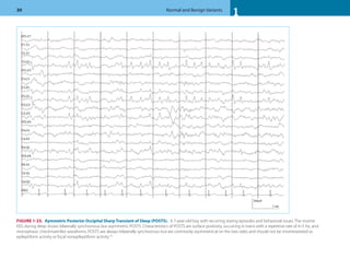 Atlas of Pediatric EEG.pdf