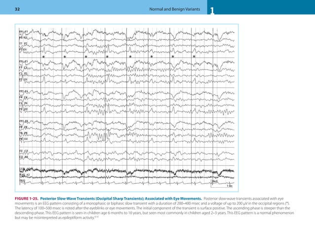 Atlas of Pediatric EEG.pdf