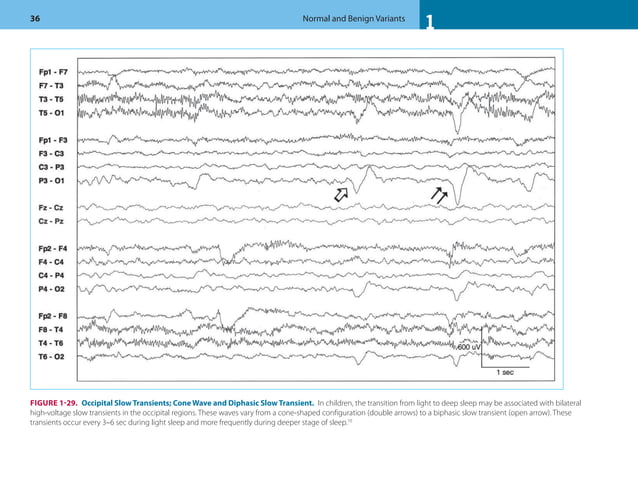 Atlas of Pediatric EEG.pdf
