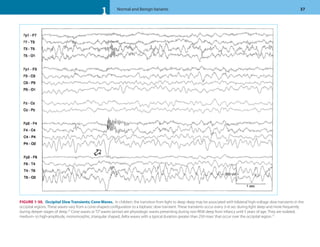 Atlas of Pediatric EEG.pdf