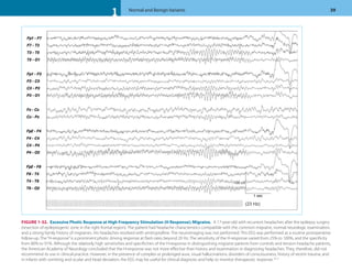 Atlas of Pediatric EEG.pdf